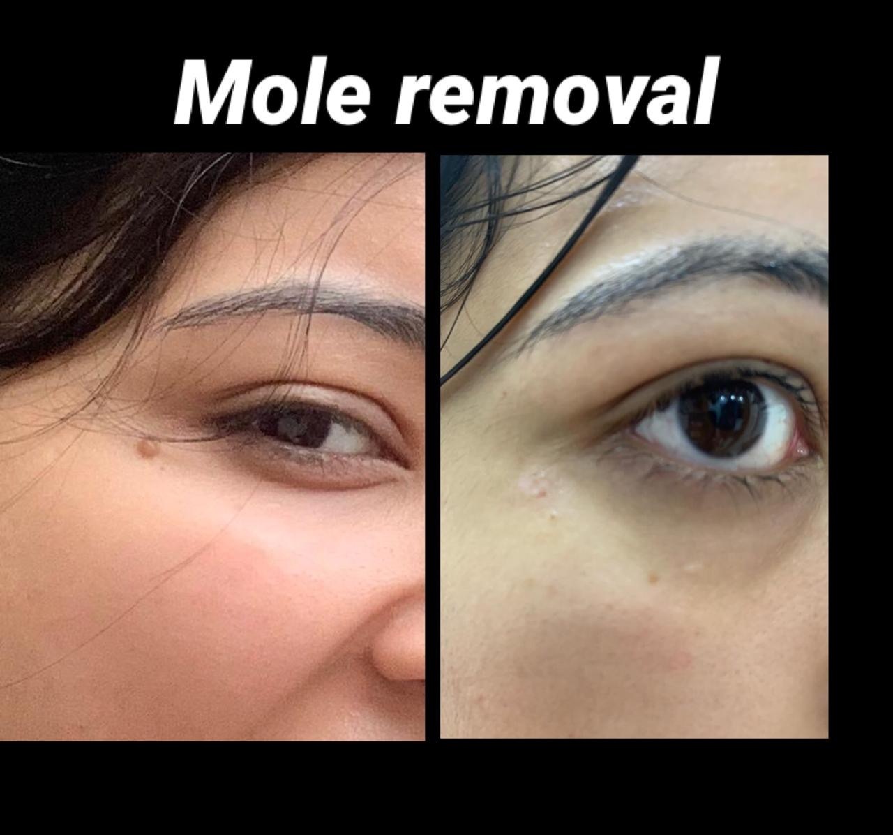 Mole Removal Services in Delhi - Dr Mahima Wadhwa skin CliniQ